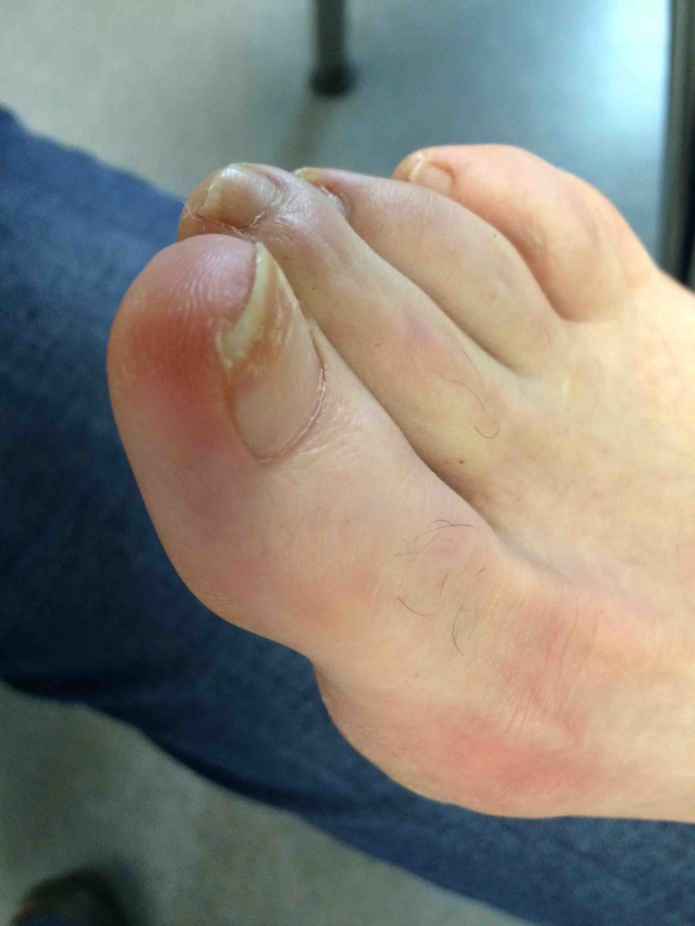 EXOSTOSE | Chirurgie-Atlantique-du-Pied