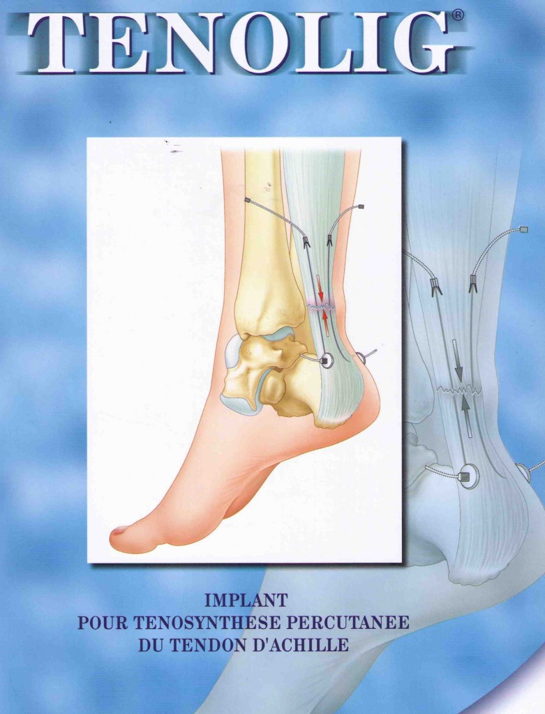 tenolig image | Chirurgie-Atlantique-du-Pied